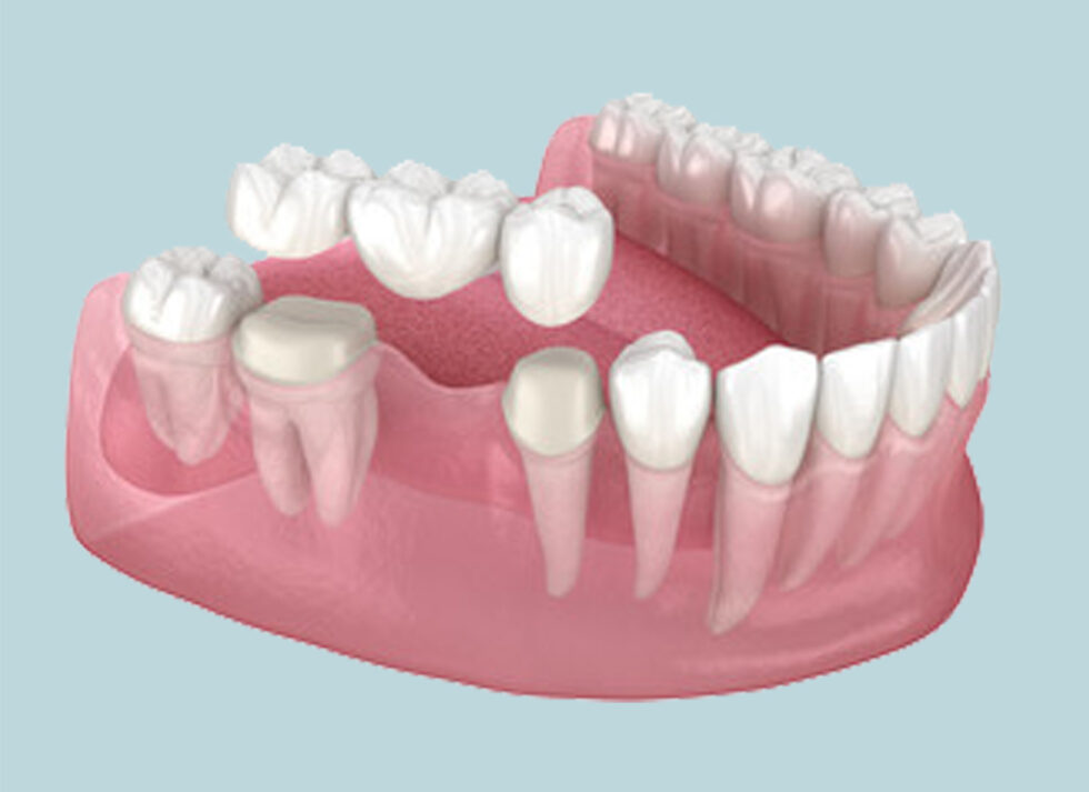 Restorative Dentistry - Forest Park Dental